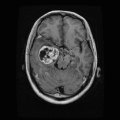 Brain Tumor 脑肿瘤数据集 | Datasets | HyperAI超神经